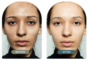 Genius RF Micro Needling - Hydra Skin Clinic